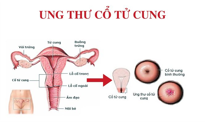 Nguyên nhân và triệu chứng của ung thư cổ tử cung - Chương trình mục tiêu quốc gia - Cổng thông ...